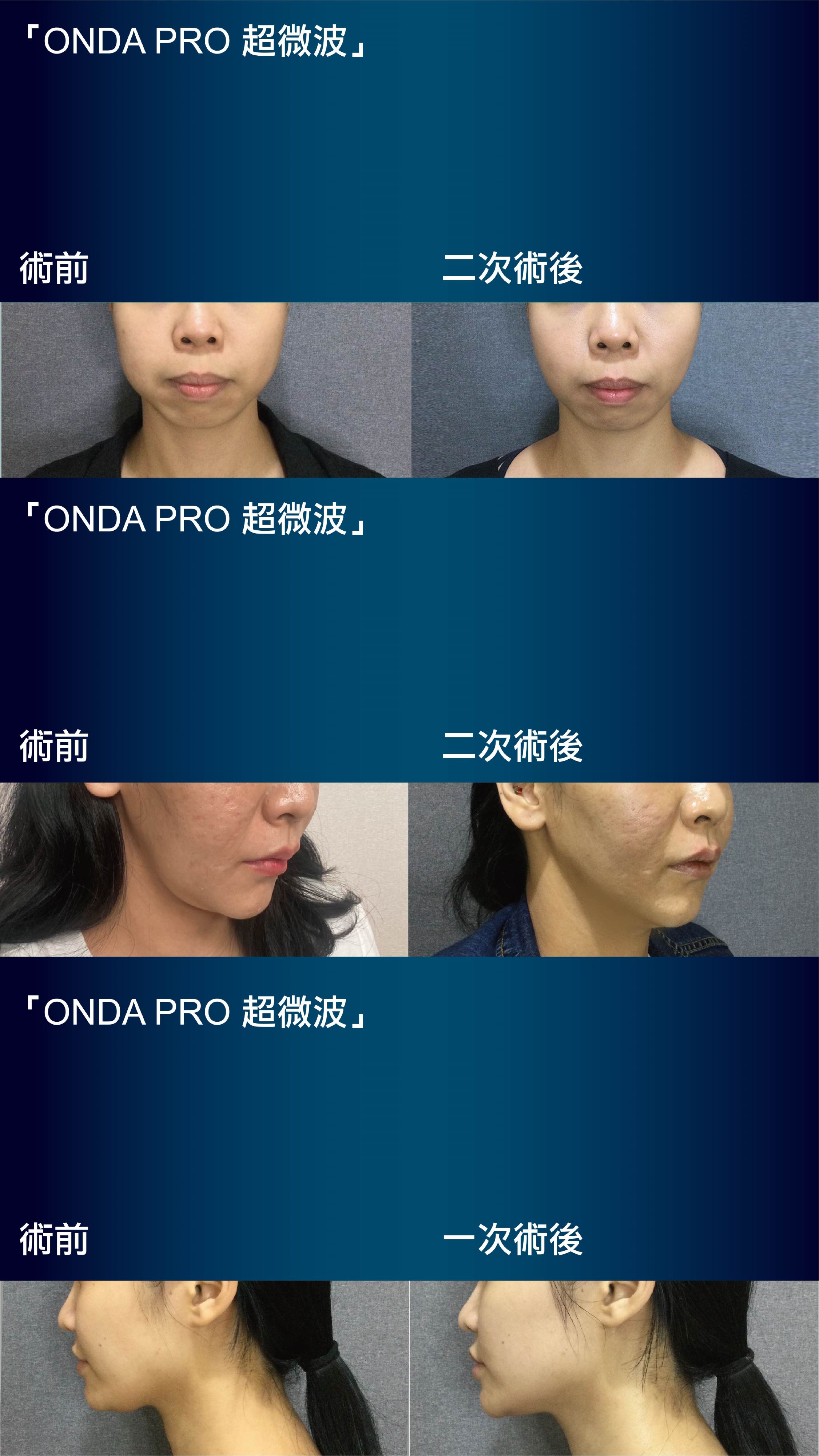 ONDA PRO超微波：重塑臉頸線條、精準打擊脂肪、完美雕塑體態 - 恩緹醫美｜變美的事交給恩緹｜anti.tw